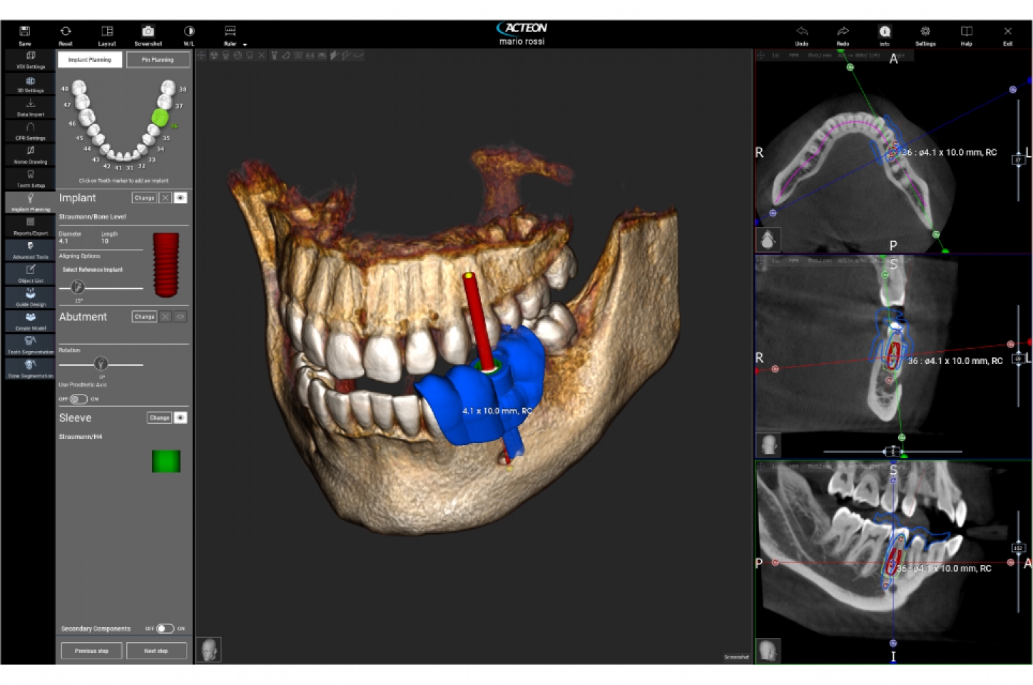 Acteon 3D CBCT rentgen X-MIND Trium 3D CEPH | CBCT a hybridní ...