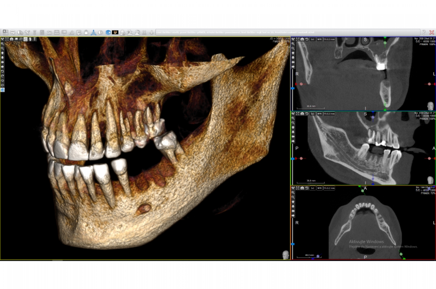 Acteon 3D CBCT rentgen X-MIND Prime 3D CEPH | CBCT a hybridní ...