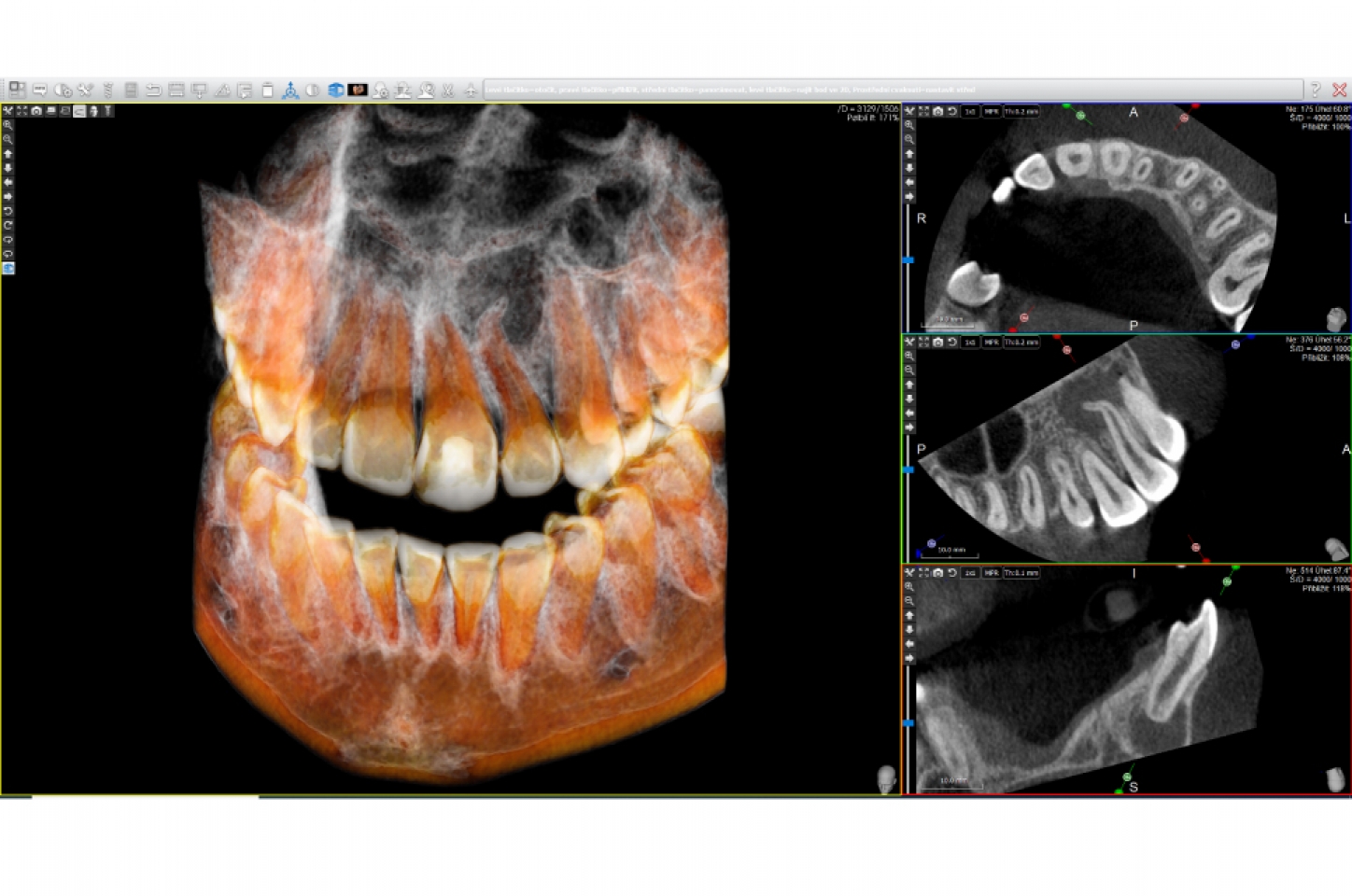Acteon 3D CBCT rentgen X-MIND Trium 3D CEPH | CBCT a hybridní ...