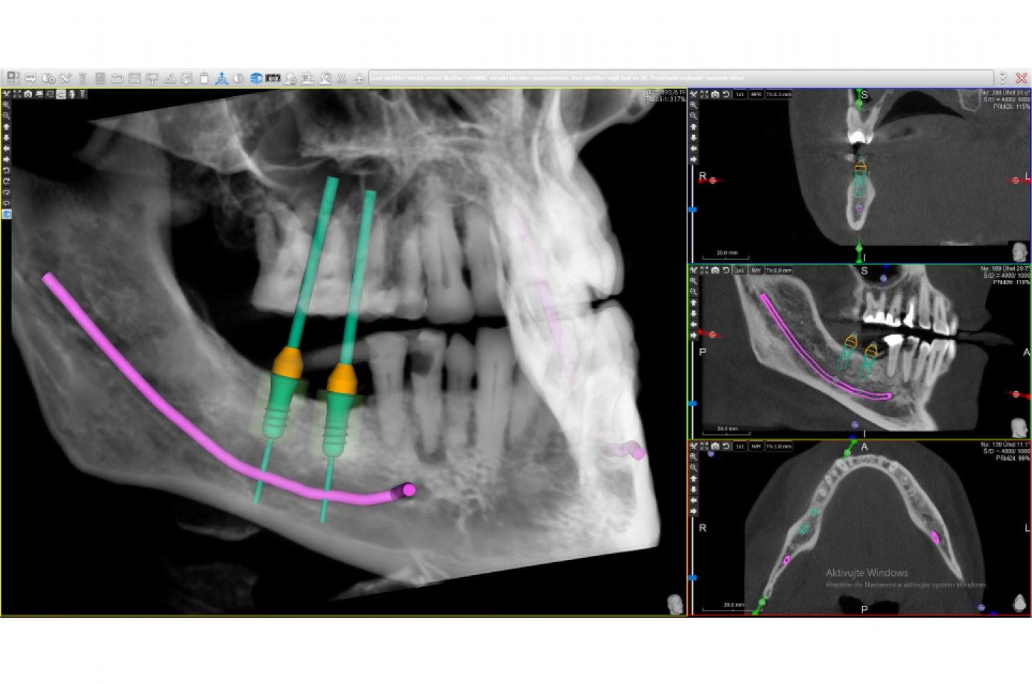 Acteon 3D CBCT rentgen X-MIND Trium 3D CEPH | CBCT a hybridní ...