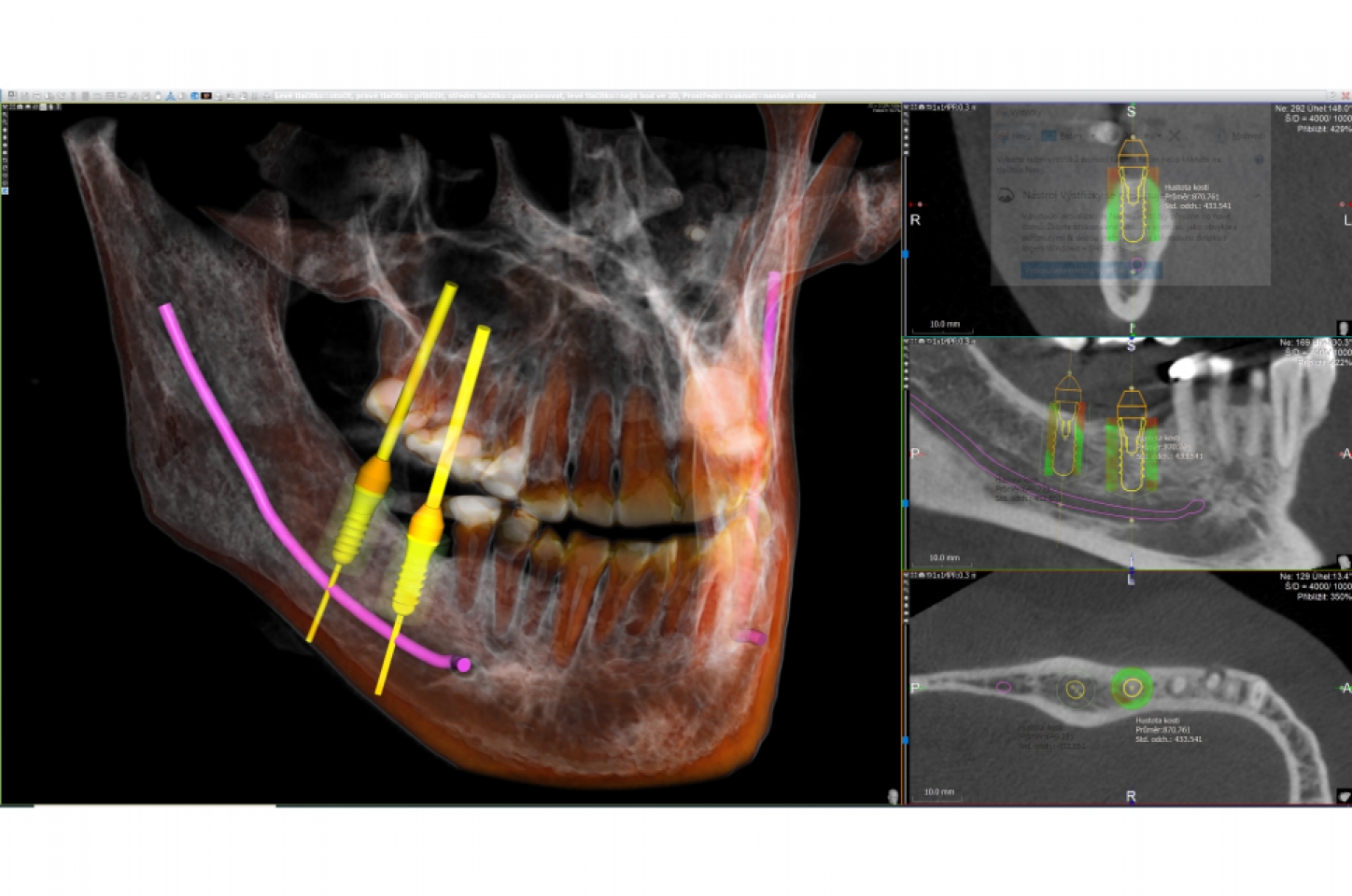 Acteon 3D CBCT rentgen X-MIND Trium 3D CEPH | CBCT a hybridní ...
