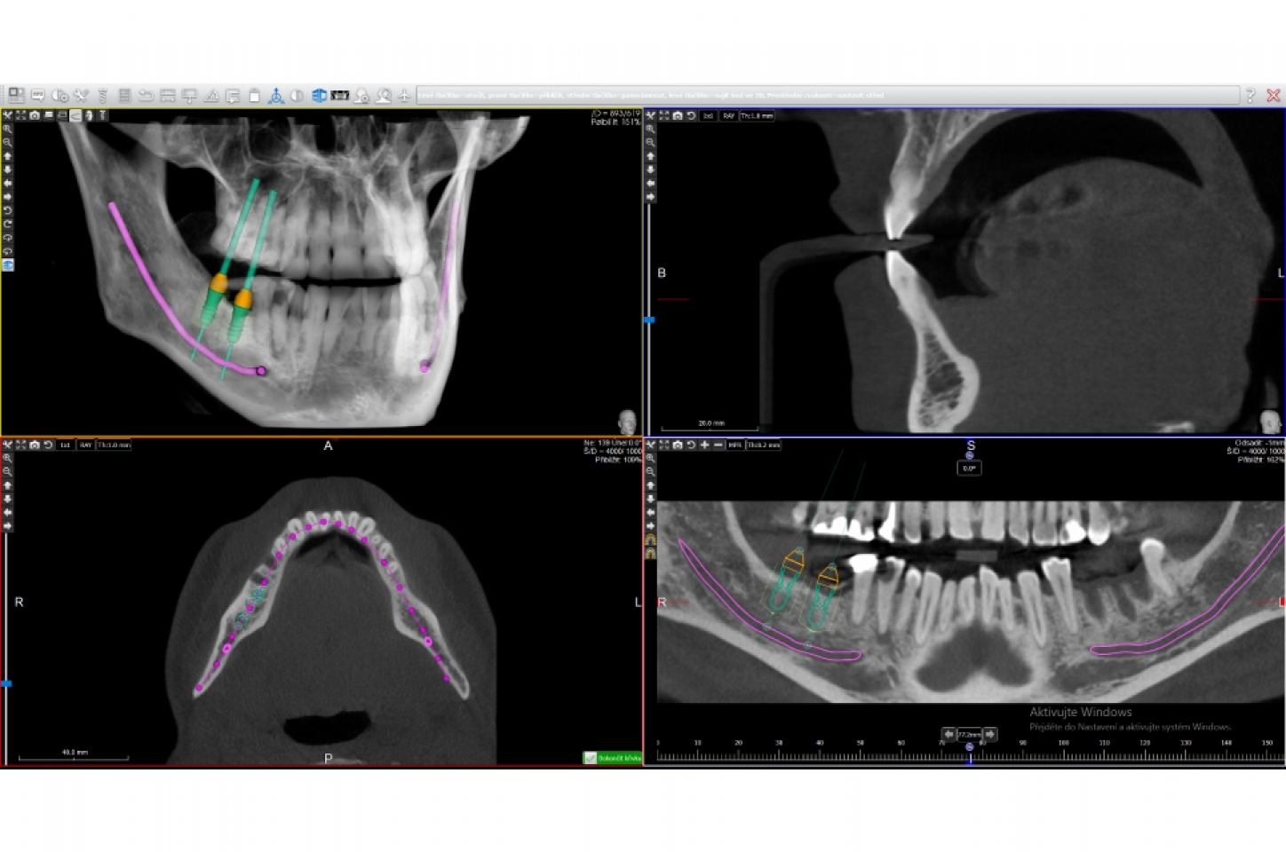 Acteon 3D CBCT rentgen X-MIND Trium 3D | CBCT a hybridní zobrazovací ...